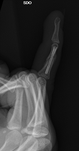Use of NX Nail for oblique fracture fixation of 2nd metacarpal.